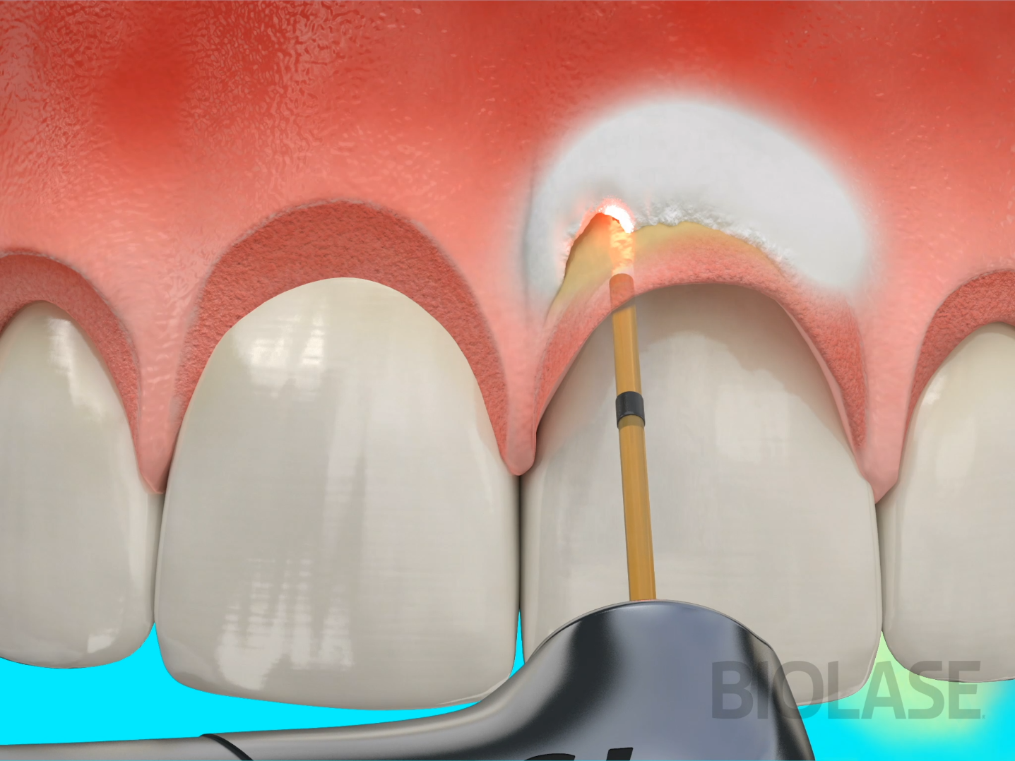 Osseous Crown Lengthening – BIOLASE Store