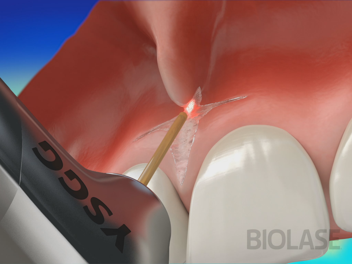 Frenectomy – BIOLASE Store