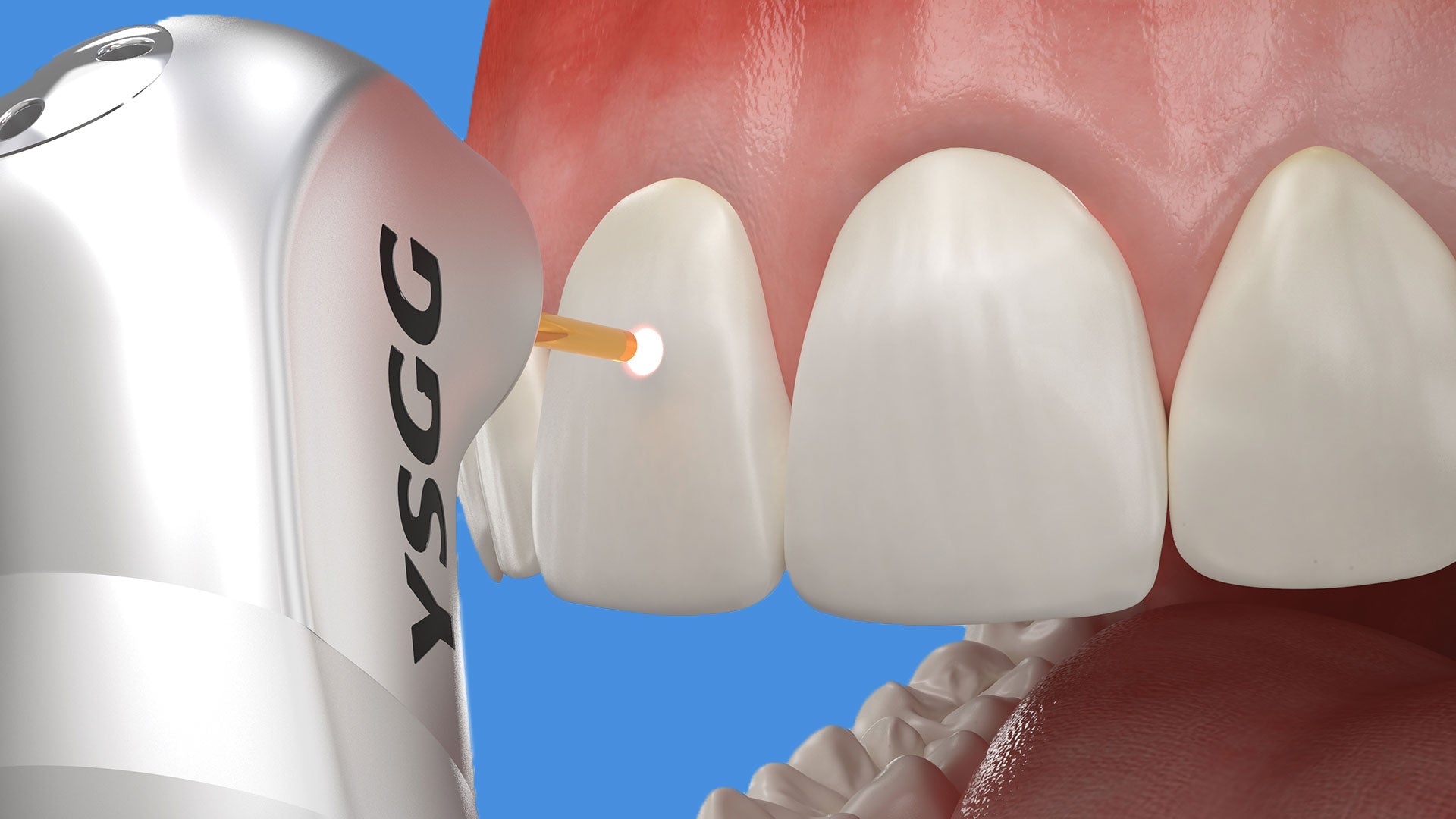 Crown and Veneer Removal – BIOLASE Store