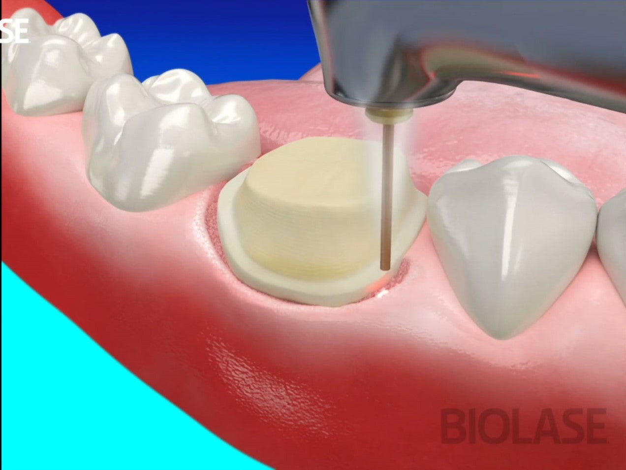 Soft Tissue Contouring and Troughing – BIOLASE Store